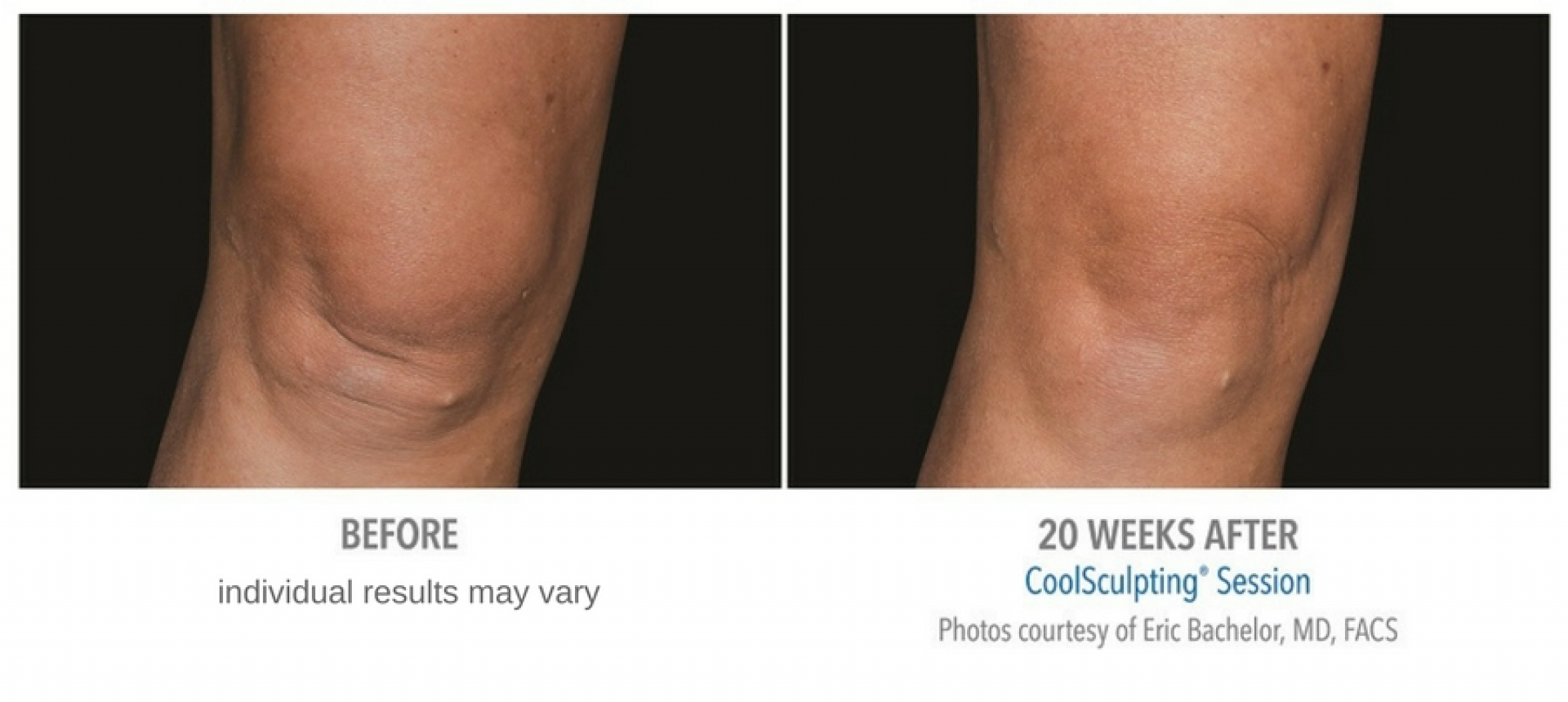 Coolsculpting Before and After Photos - Center For Medical Aesthetics
