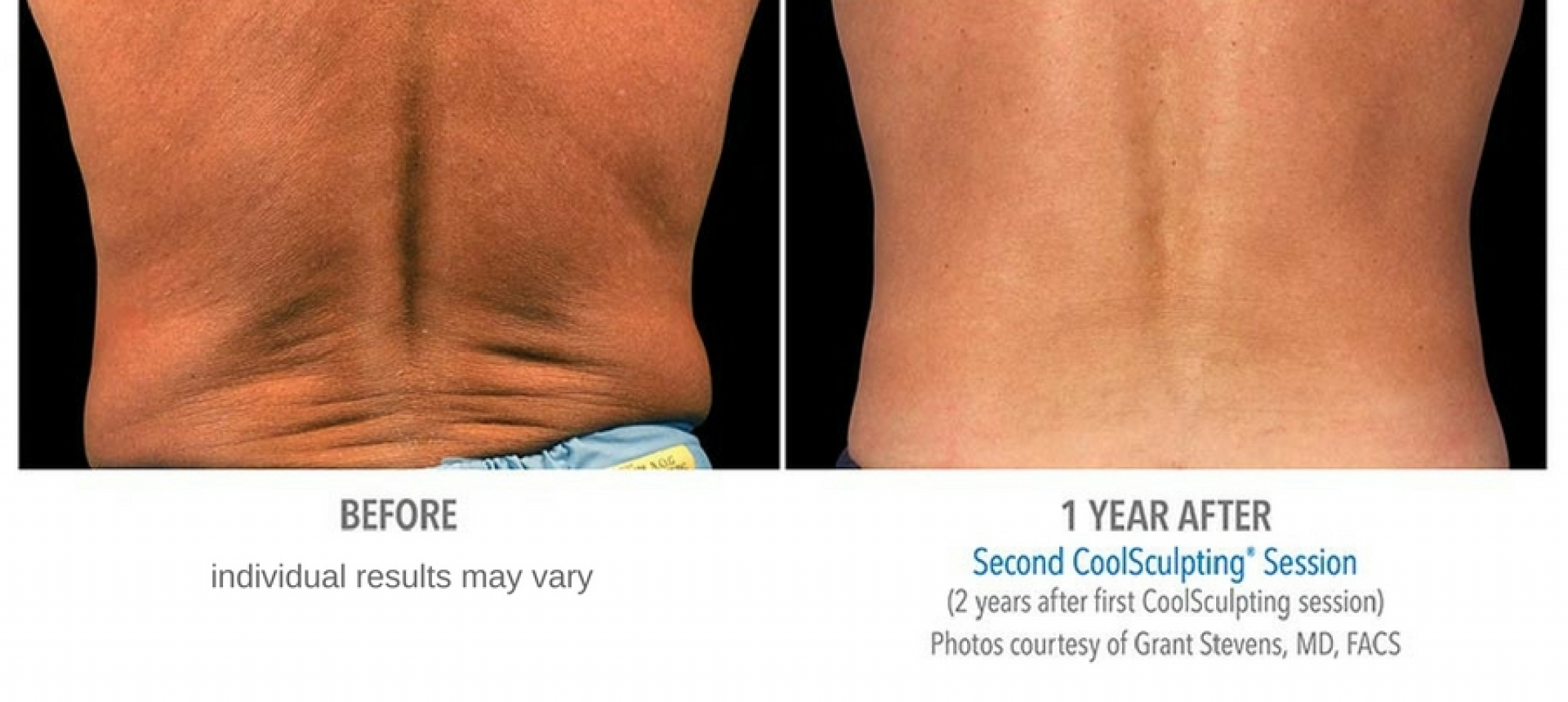 Coolsculpting Before and After Photos - Center For Medical Aesthetics